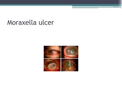 Bacterial Corneal Ulcer 2 Pptx Cornea Pptx