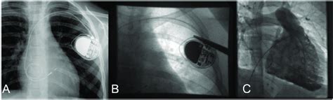 Serial Chest X Raysfluoroscopy Images In Case 2 A At Initial