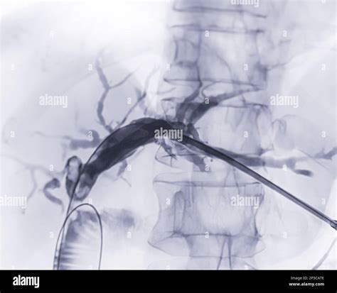 X Ray Image Of Portal Vein After Doctor Doing Ercp And Laparoscopic