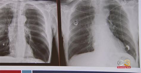 New Treatment For People With Copd Emphysema At Penn Medicine Cbs Philadelphia