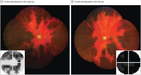 Bilateral Fundus Hypopigmentation In A Patient With Glaucoma Ophthopedia