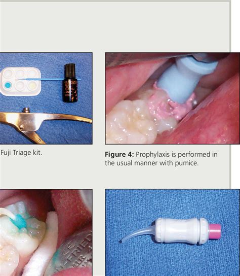 Glass Ionomer Sealer At Tyson Walsh Blog