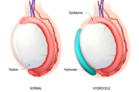 Hydrocele Causes Symptoms Treatment And Complications Factdr