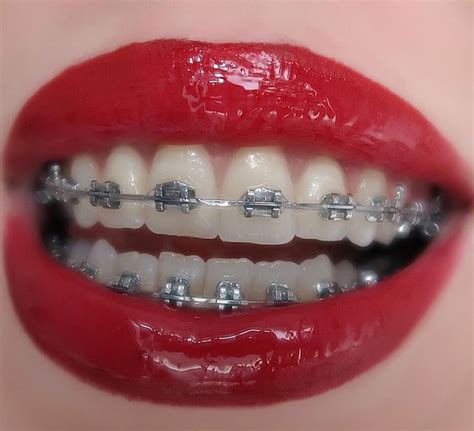 Pink Braces Silver Braces Cute Braces Braces Colors Purple