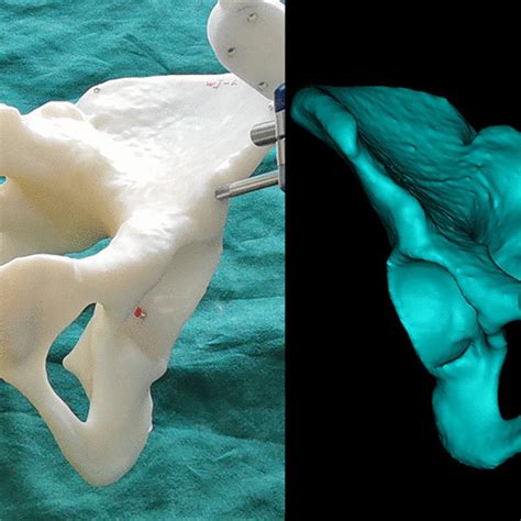 Intelligent Robot Assisted Fracture Reduction System For Pelvic Fracture Download Scientific