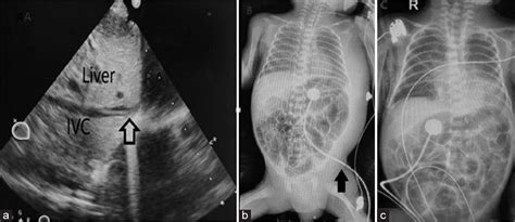 Peripherally Inserted Central Catheter Extravasation Of Fluid In A Neonate A Dreadful