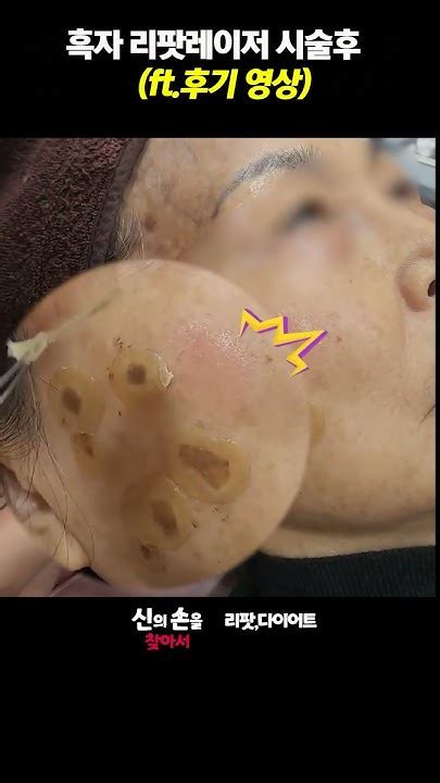흑자 리팟레이저 시술후ft시술 후기 영상흑자제거 잡티제거 검버섯제거 Drwellness5977 Youtube