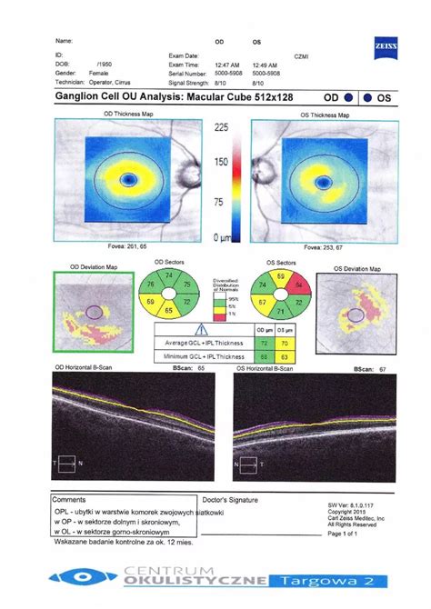Oct Gcl Warszawa Diagnostyka Jaskry Amd I Innych Chorób Oczu