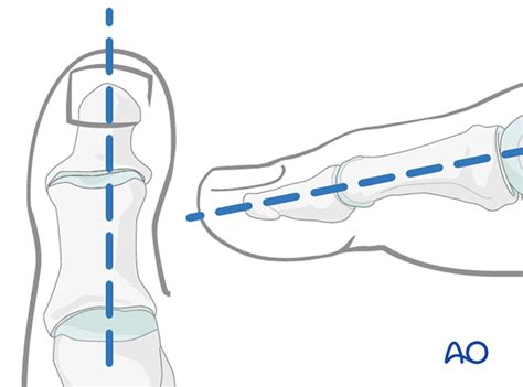 Crif K Wire Fixation For Mtp Joint Dislocation
