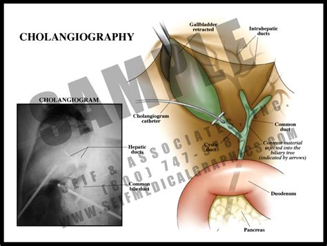 Cholangiography Procedure 51 Off Gt