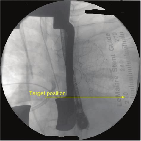 Deployment Of A Stent Graft Under Fluoroscopy A Radiopaque Ruler