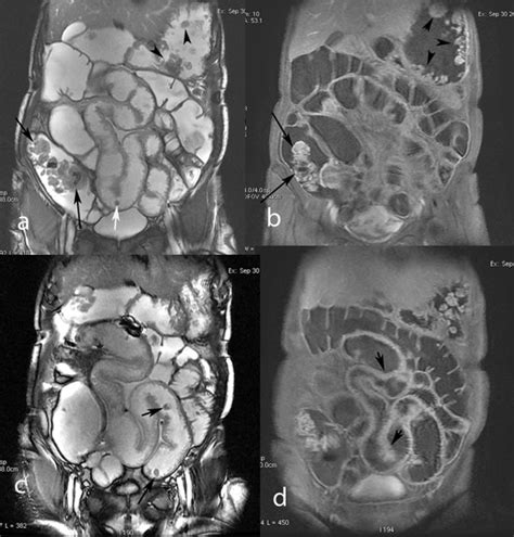 Peutz Jeghers Syndrome Pacs