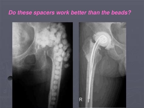 Antibiotic Cement Spacer For Infected Hip Joint Replacement Thr Sur