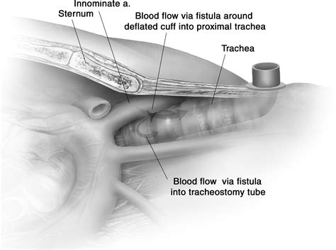 Technique For Managing Tracheo Innominate Artery Fistula Operative