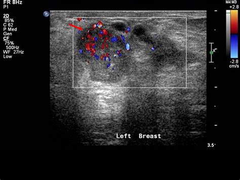 Atlas Of Breast Cancer Early Detection