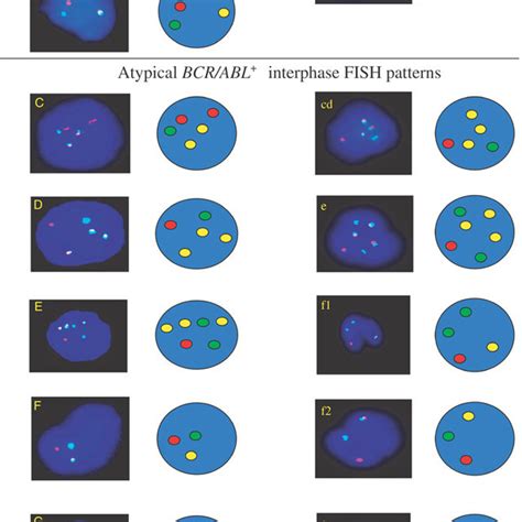 Pdf Patterns Of Bcrabl Gene Rearrangements By Interphase
