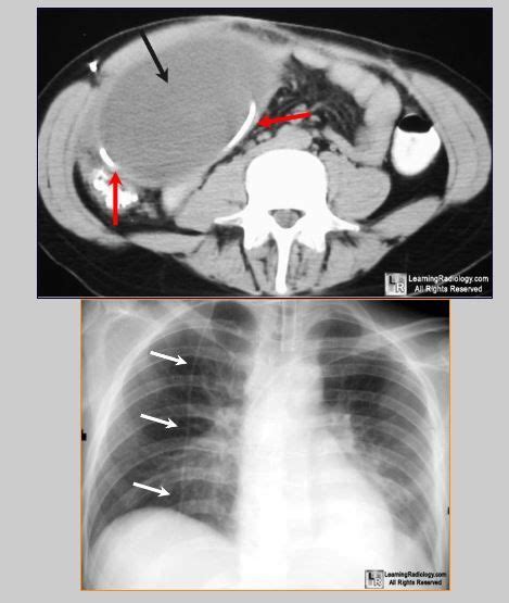 Tree In Bud Radiology Socorro Neel