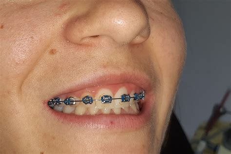 Cazuistica Aparate Ortodontice Roxydent