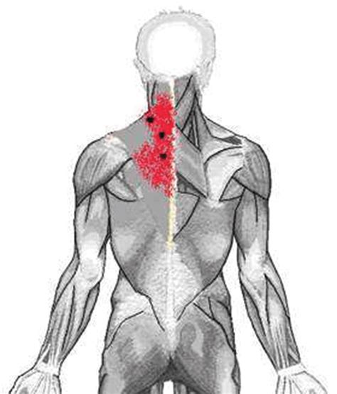 Complications Of Trigger Point Injection Anesthesia Key
