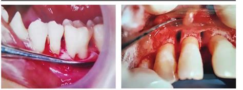 Pdf Periodontal Osseous Defects A Review
