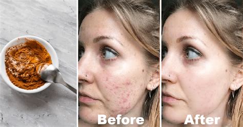 How To Remove Scars From Face Naturally Glowpink