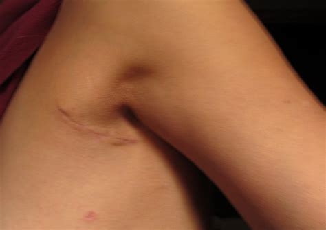 Thoracic Outlet Decompression Surgery