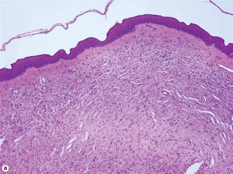 Neural Tumors Clinical Tree