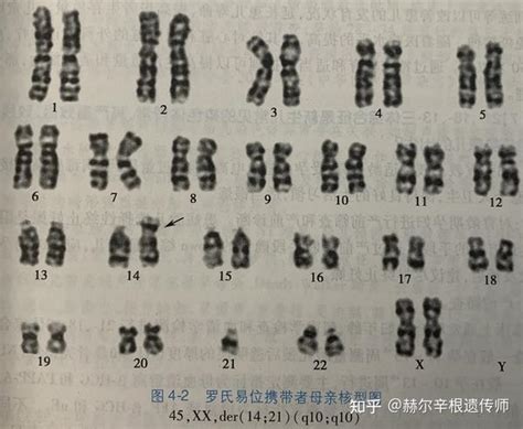 21三体综合征 唐氏综合征疾病介绍应对策略及筛查诊断方法 知乎