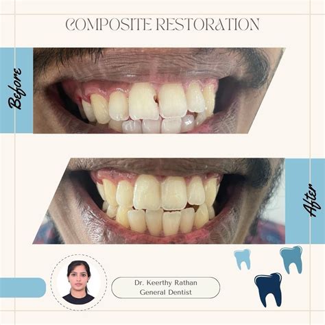 Dr Keerthy Rathan On Linkedin On This Case Class 3 Caries 11