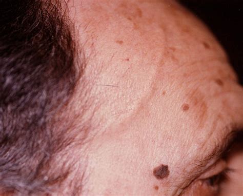 Temporal Arteritis Medical Point