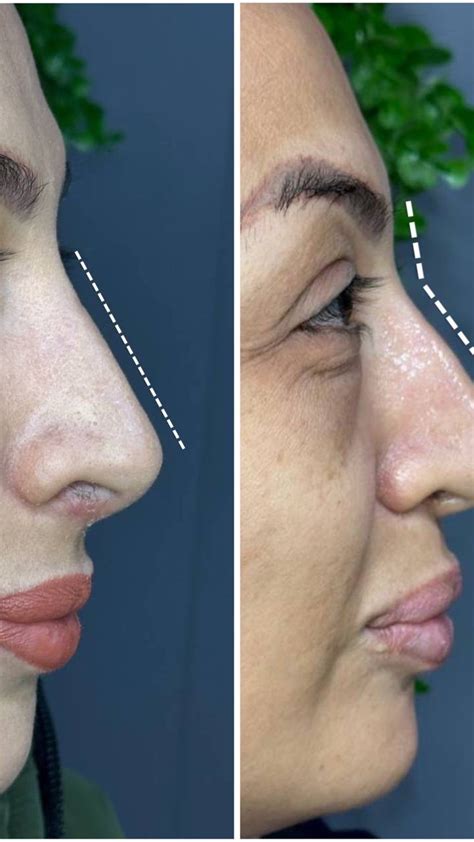 ‎دکتر نوشین رضاخانی Dr Nooshin Rezakhani‎ ‎چه فیلر بینی اییییی💪😎 این روش یک جایگزین مناسب برای