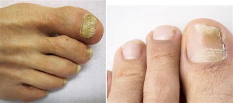 شکل ظاهری قارچ پوستی سفیدرنگ قهوه ای و همه سالم زیبا