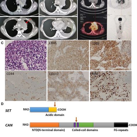 A The Result Of Lung Ct Enhancement For Case 3the Tumor Is Marked
