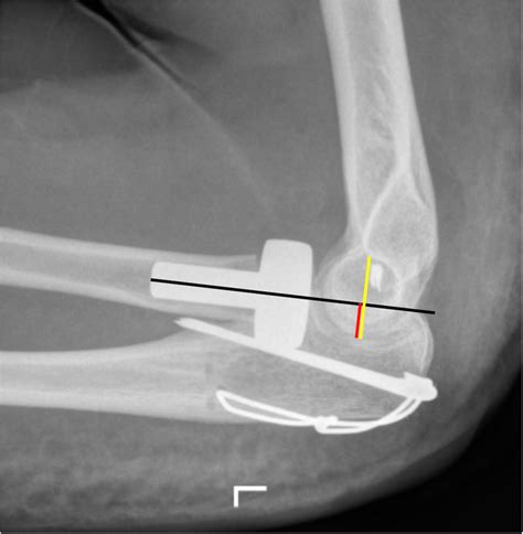 Radiocapitellar Alignment Was Determined By The Quotient Of The Red