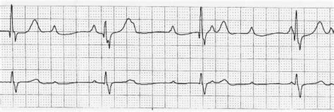 Transcutaneous Pacing Review Nursing Ce Central