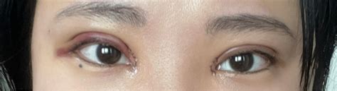 자유수다 쌍꺼풀 세미아웃라인 강남언니 1등 성형수술and피부시술 정보앱