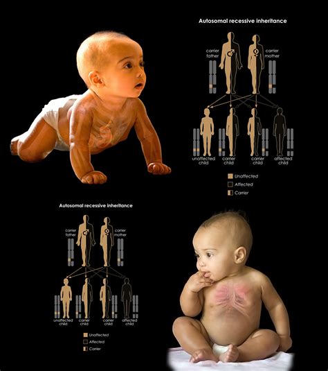 Alpha Thalassemia Symptoms