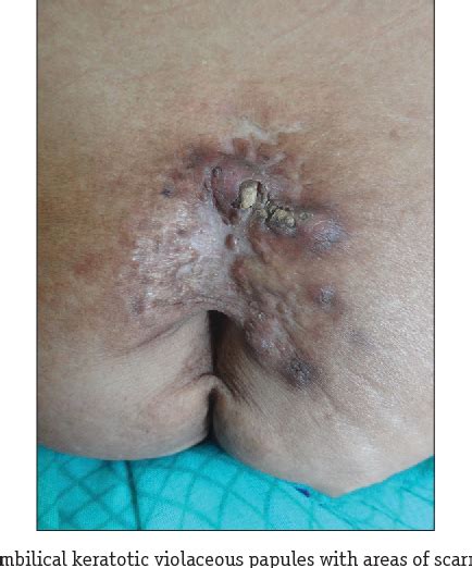 Figure 1 From Perforating Calcific Elastosis Revisiting A Rare Entity