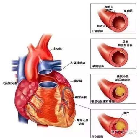 二十张图教你秒懂心血管疾病（医学生收藏） 知乎