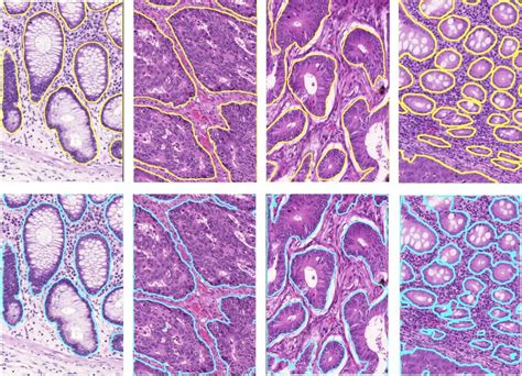 The Colon Gland Segmentation Result Contour Colors Yellow Manual Download Scientific