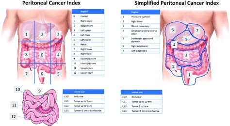 Overview Of Sugarbakers Peritoneal Cancer Index Left And The Dutch
