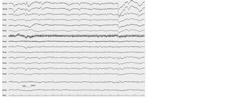 Eeg Recordings Of Patient 1 During The Clinical Ictal Phase