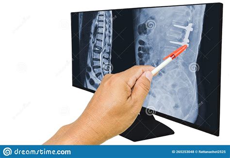 The Doctor Reported The Mri Scans Of The Lumbar Spine Compression Fracture Bulging Of L1 L2 And