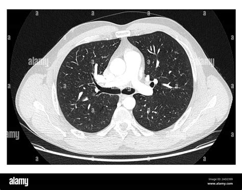 Illustration Of The Lungs Pulmonary Segmentation In Thoracic Ct This