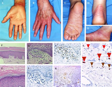 Jle European Journal Of Dermatology Nagashima Type Palmoplantar Keratosis Associated With