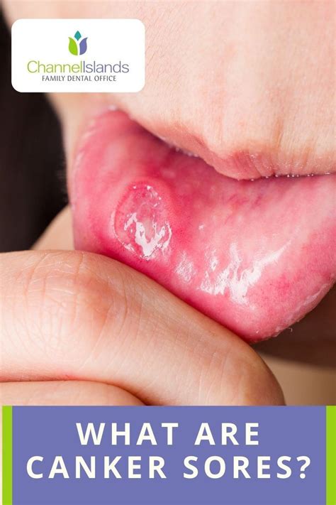Canker Sore Artofit