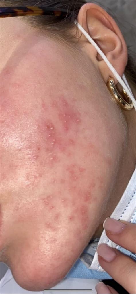 Not Sure Its Melasma I Threaded My Upper Lip It Keeps Getting Darker