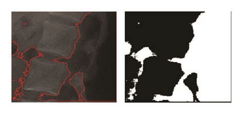 Segmentation Results On Lumbar Spine Image With Two Object Regions