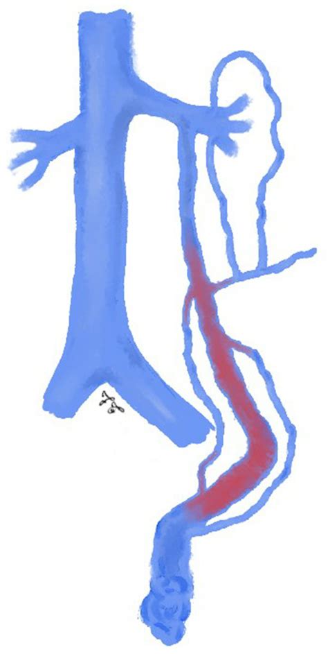 Liquid And Solid Embolic Agents In Gonadal Veins