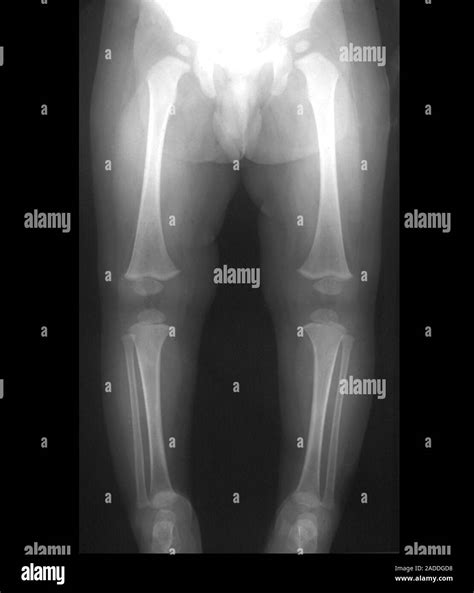 Leg Bones Of 18 Month Old Infant Frontal X Ray This X Ray Shows The Normal Ossification